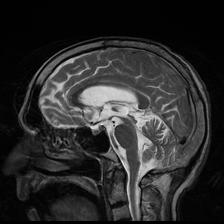 Parálisis supranuclear progresiva - espacioLogopedico